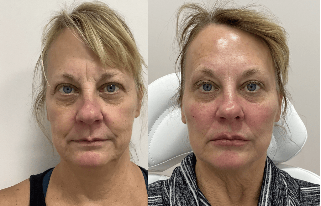 Botox® & Dysport® Injections Madison, WI